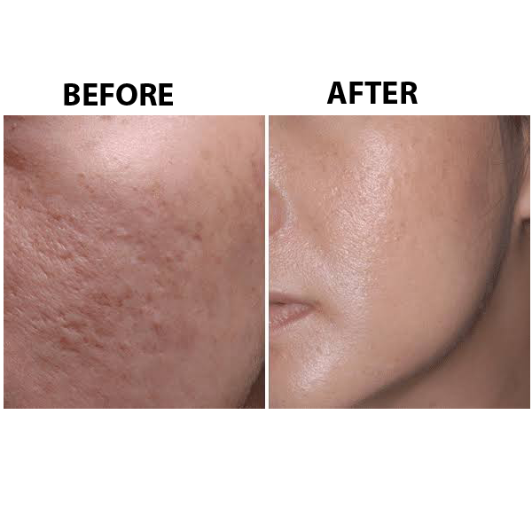 Acne Spot Injection - Perpetual Beauty and Wellness