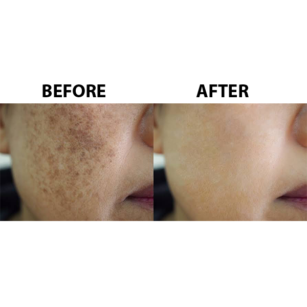 Pigment Laser Treatment - Perpetual Beauty and Wellness