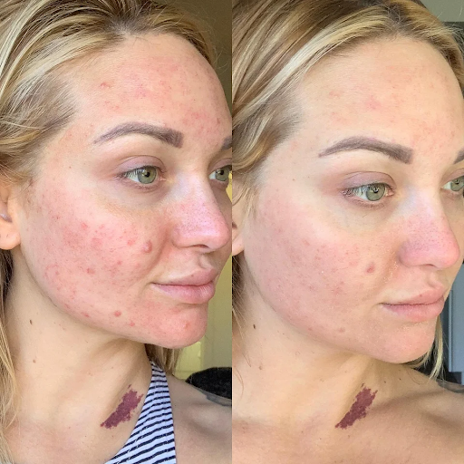 Pepfactor™ - Skin and Scalp Treatments - Perpetual Beauty and Wellness