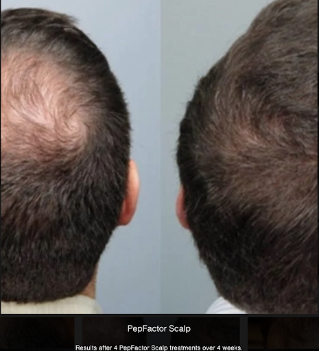 Pepfactor™ - Skin and Scalp Treatments - Perpetual Beauty and Wellness