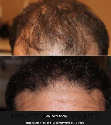 Pepfactor™ - Skin and Scalp Treatments - Perpetual Beauty and Wellness